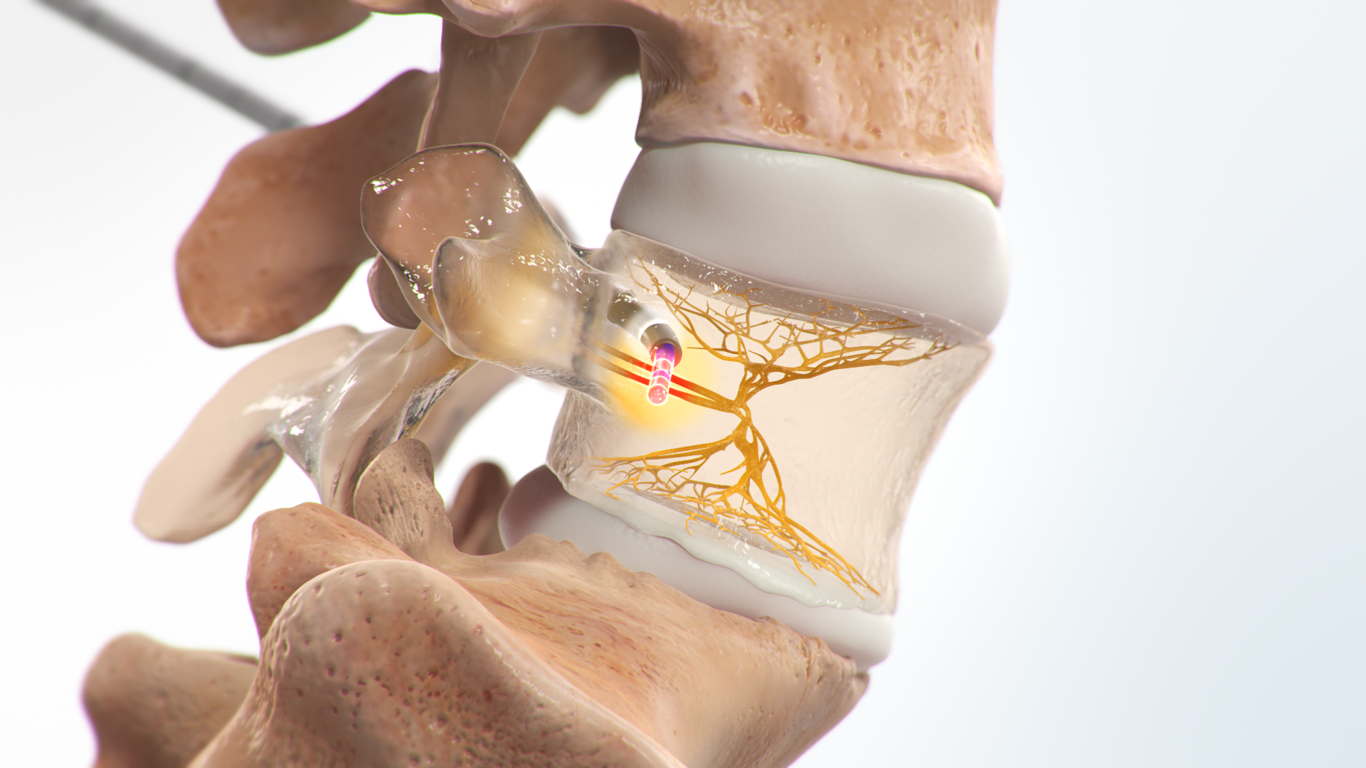 Intracept® Procedure - Olympia Orthopaedic Associates PLLC